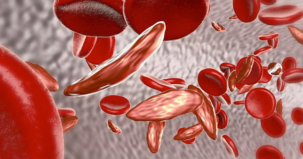 6 signos para reconocer anemia de células falciformes - ClikiSalud.net ...