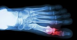 4 consejos para tratar un dedo roto del pie previo a que vayas al ...