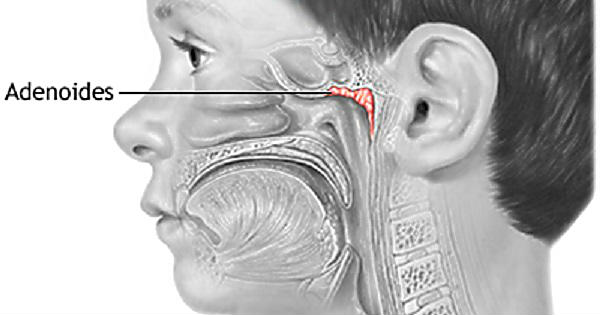 ¿Qué es una adenoidectomía y cuándo debe practicarse en los niños ...