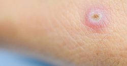 ¿Tienes un absceso? Aquí 4 signos de que debes acudir al médico ...