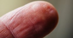 Infección en la punta del dedo, lo que debes saber