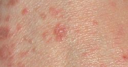 ¿Cómo afecta el VIH a la piel? - ClikiSalud.net | Fundación Carlos Slim