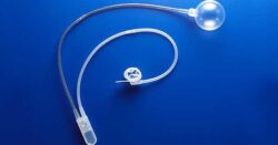 Esfínter artificial para incontinencia urinaria en hombres, lo que ...