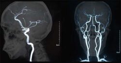Angiografía por resonancia magnética, ¿qué es y para qué se utiliza?