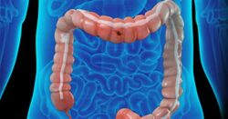 Perforación gastrointestinal, lo que debes saber