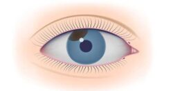 6 estructuras del ojo que afecta el melanoma ocular