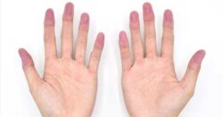 La condición en la que la piel o los labios se vuelven de color azul