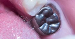 Amalgama dental, ¿qué es y para qué la colocan los dentistas?