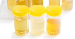 Color de la orina, ¿qué dice sobre la salud del tracto urinario?