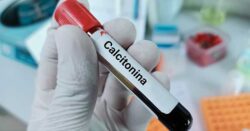 Prueba de calcitonina, ¿qué es y para qué la realizan los médicos?