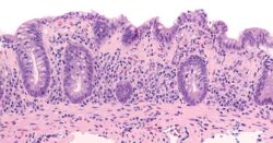 Colitis colágena, ¿qué es y cuáles son sus síntomas?