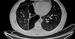 Enfisema bulloso, ¿qué es y cuáles son sus síntomas?