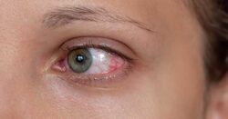 Hemorragia subconjuntival, ¿qué es y cómo afecta la salud visual?