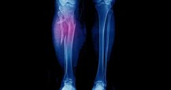 Síndrome compartimental de esfuerzo crónico, ¿qué es y cuáles son sus ...