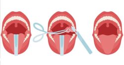 Cirugía para extirpar las amígdalas, lo que debes saber