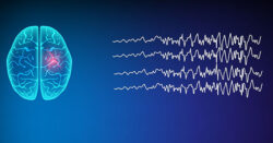 Convulsiones de epilepsia focales, información clave que debes conocer