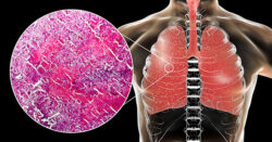 Tuberculosis miliar, lo que debes saber